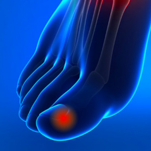 Ingrown Toenails | NextGen Foot and Ankle of LA